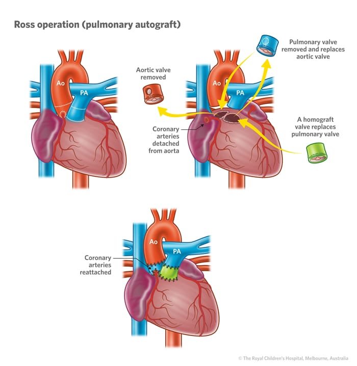 عملية روس للقلب : ROSS OPERATION - موقع قلب اطفال